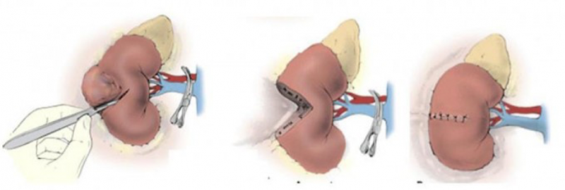 Niertumoren - Urologie Tielt